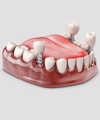 3D Implant in Mountain Home, AR - Dover Family Dentistry